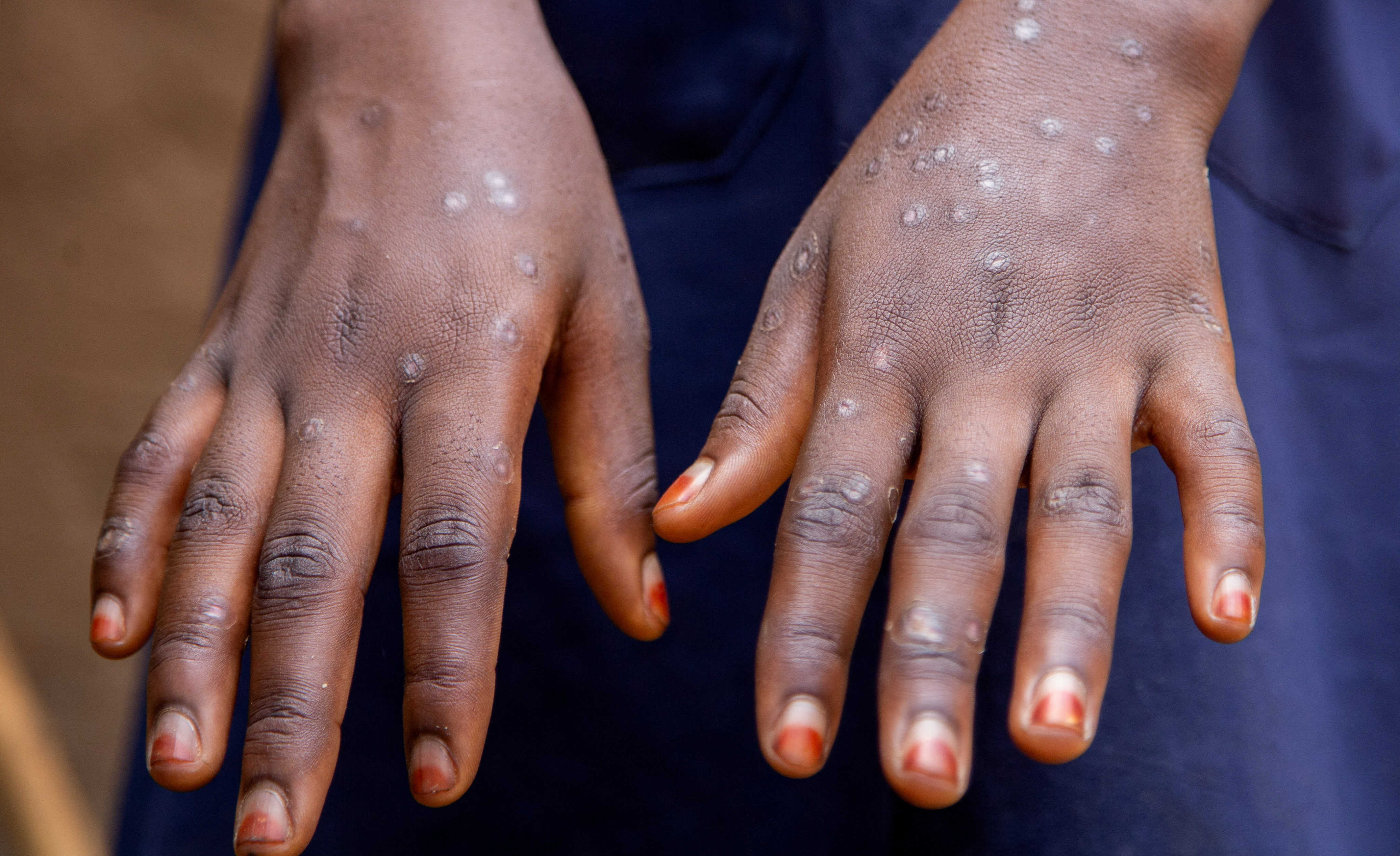Spark: Fake information and the global mpox emergency | Young Post Club